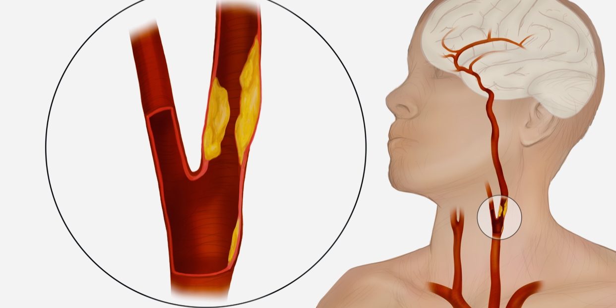 TCAR Procedure: TransCarotid Artery Revascularization - Birmingham ...